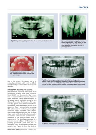 Part 10 impacted teeth | PDF | Dental Health | Diseases and Conditions