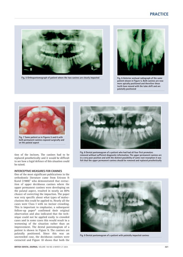 Part 10 impacted teeth | PDF | Dental Health | Diseases and Conditions