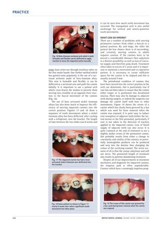 Part 10 impacted teeth | PDF | Dental Health | Diseases and Conditions