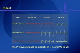Part 1 ecg 2019 yarmok | PPT