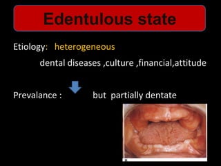 The edentulous state, bucher part 1 | PPT