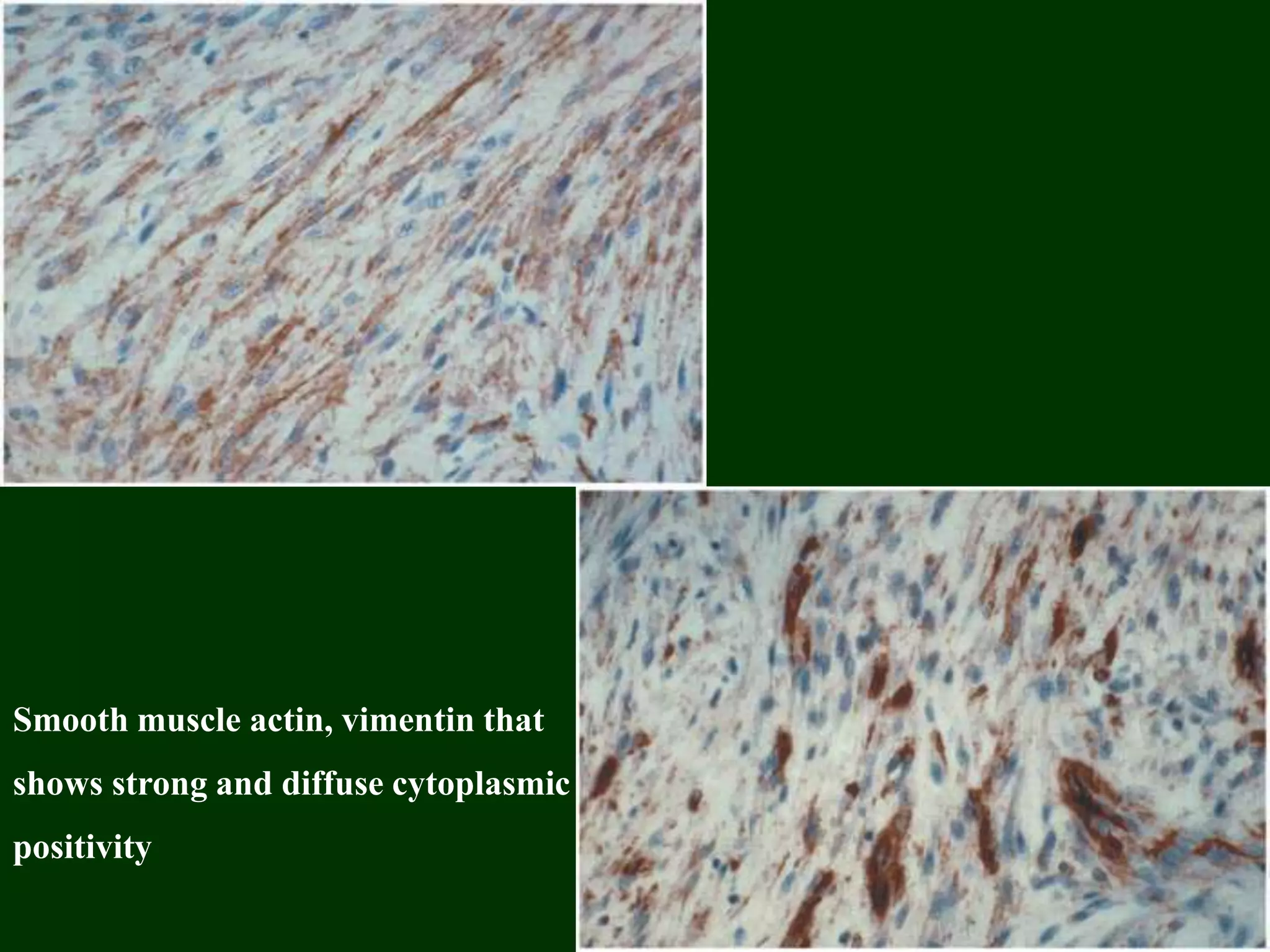 PART 1: SPINDLE CELL LESIONS.pptx
