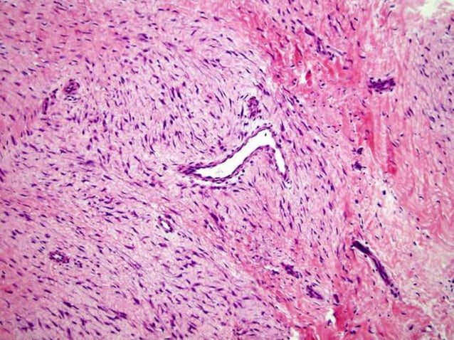 PART 1: SPINDLE CELL LESIONS.pptx | Dental Health | Diseases and Conditions