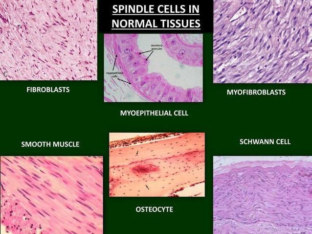 PART 1: SPINDLE CELL LESIONS.pptx | Dental Health | Diseases and Conditions