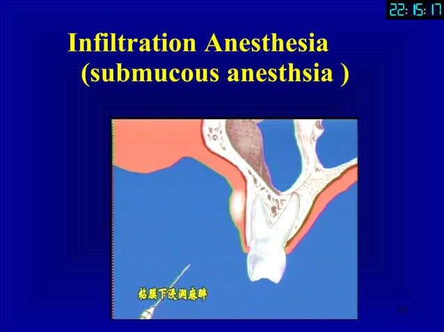 Part2.Anesthesia | PPT
