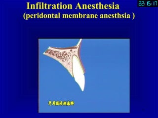 Part2.Anesthesia | PPT