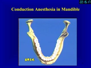 Part2.Anesthesia | PPT