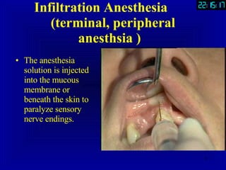 Part2.Anesthesia | PPT