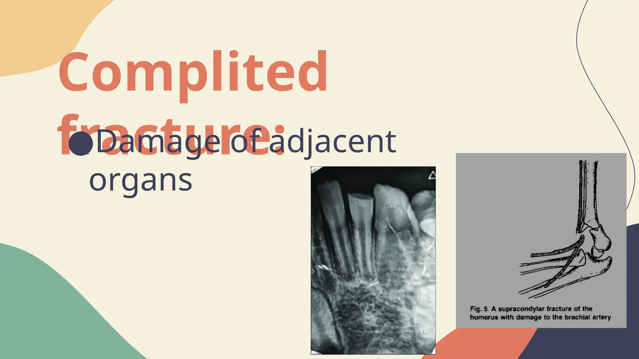 part 2-Fracture and bleeding-------.pptx