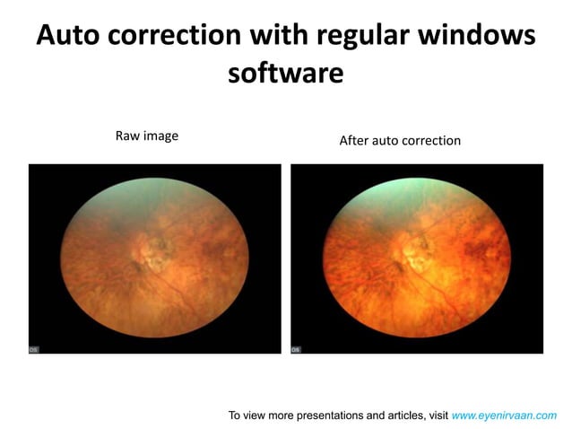 Part 2 fundus imaging – presentation for www.eyenirvaan.com