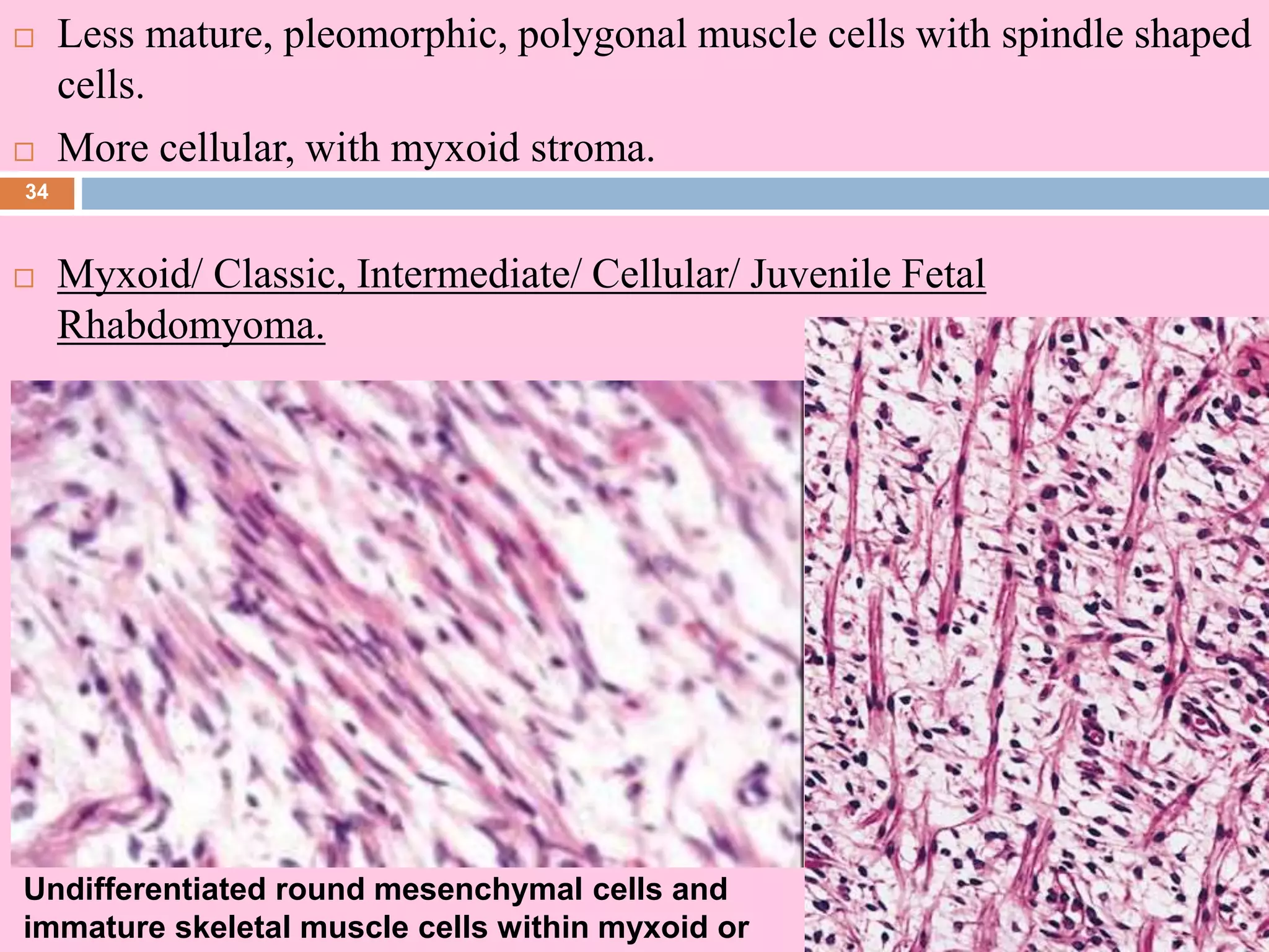 PART 2 spindle cell tumors.pptx