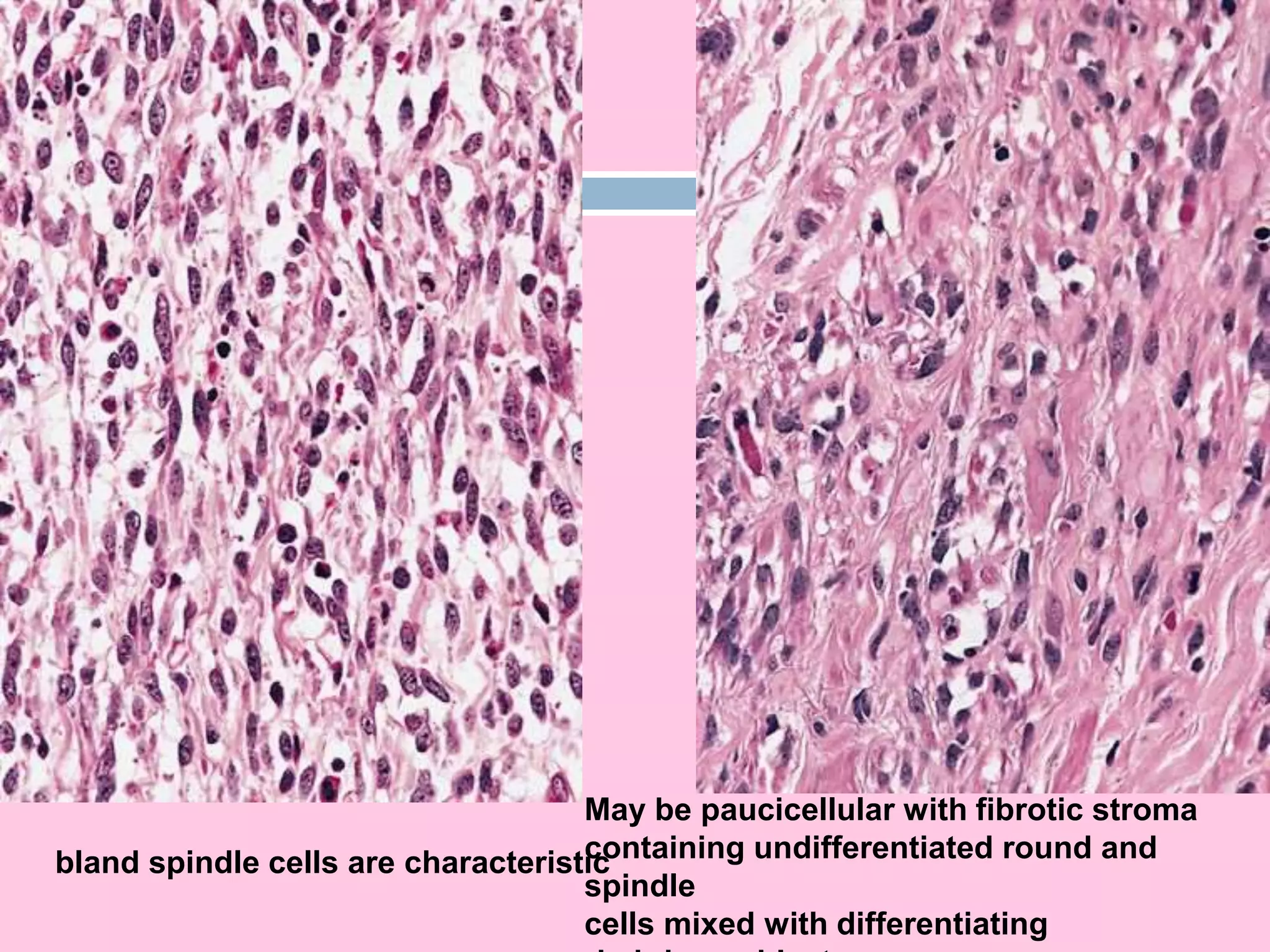 PART 2 spindle cell tumors.pptx