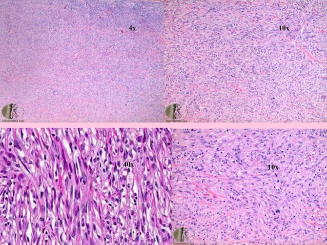 PART 2 spindle cell tumors.pptx