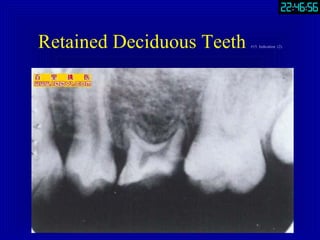 Part3.Extraction Of Teeth | PPT