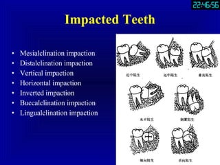Part3.Extraction Of Teeth | PPT