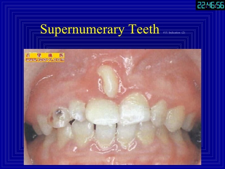 Part3.Extraction Of Teeth