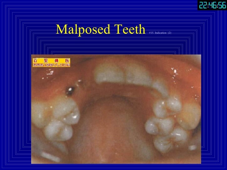 Part3.Extraction Of Teeth