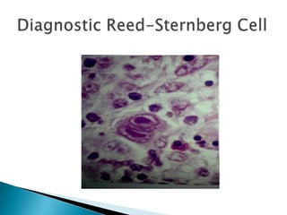 Part 3 Hodgkins Lymphoma | PPT