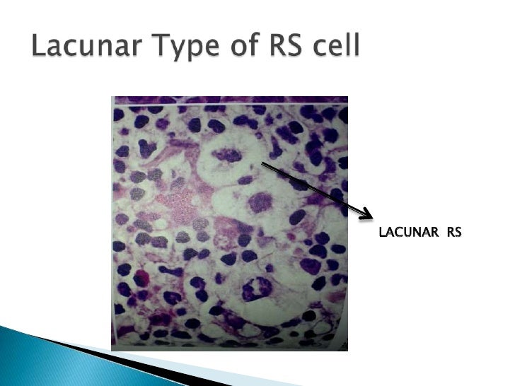 Part 3 Hodgkins Lymphoma