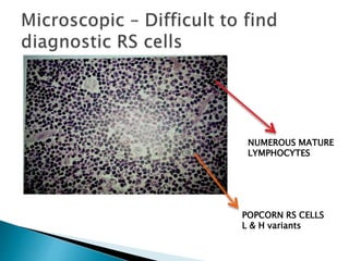 Part 3 hodgkins lymphoma | PPTX