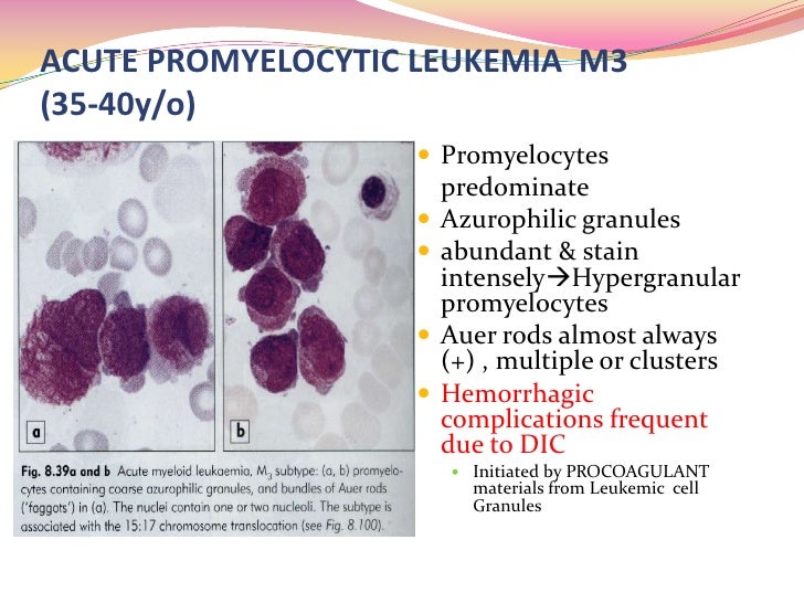 Leukemia Promyelocytic Acute Leukemia Myeloid Acute M3 Leukemia