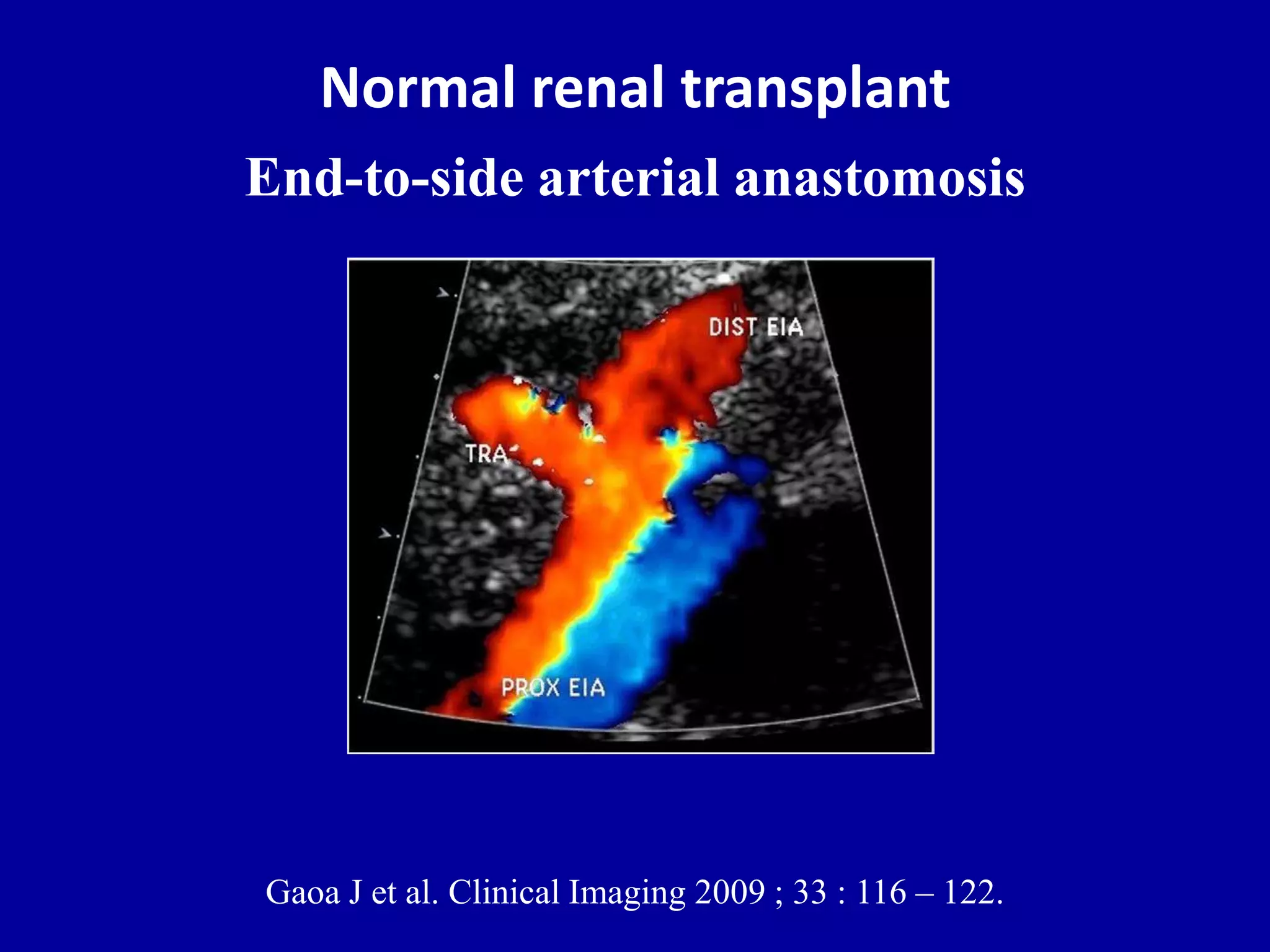 Part 4 doppler usg of renal artery stenosis in transplant kidney | PPT