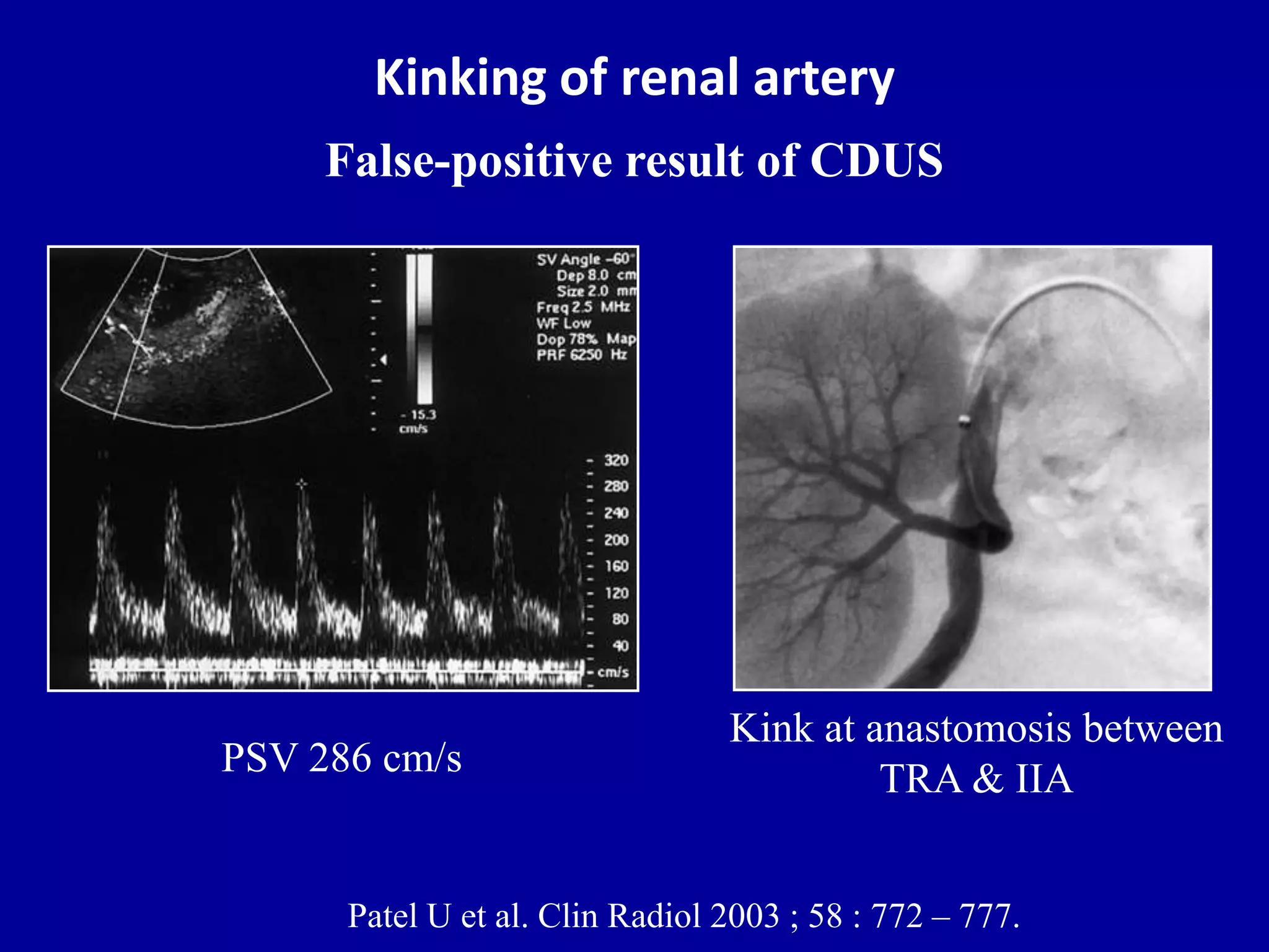 Part 4 doppler usg of renal artery stenosis in transplant kidney | PPT