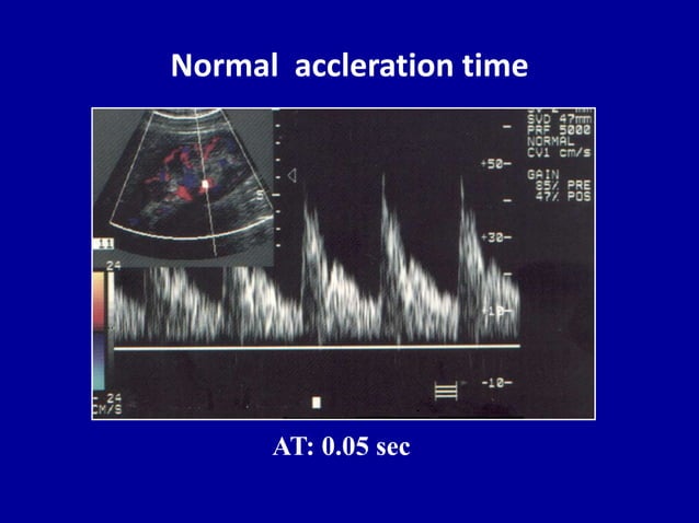 Part 4 doppler usg of renal artery stenosis in transplant kidney | PPT