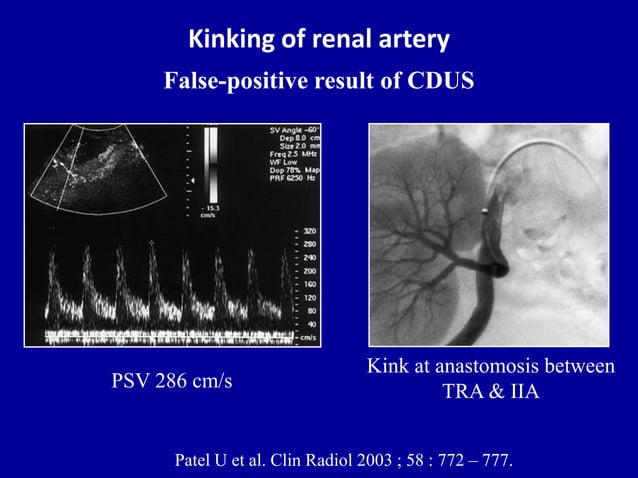 Part 4 doppler usg of renal artery stenosis in transplant kidney | PPT