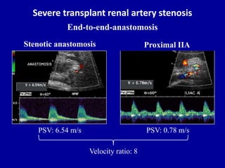 Part 4 doppler usg of renal artery stenosis in transplant kidney | PPT