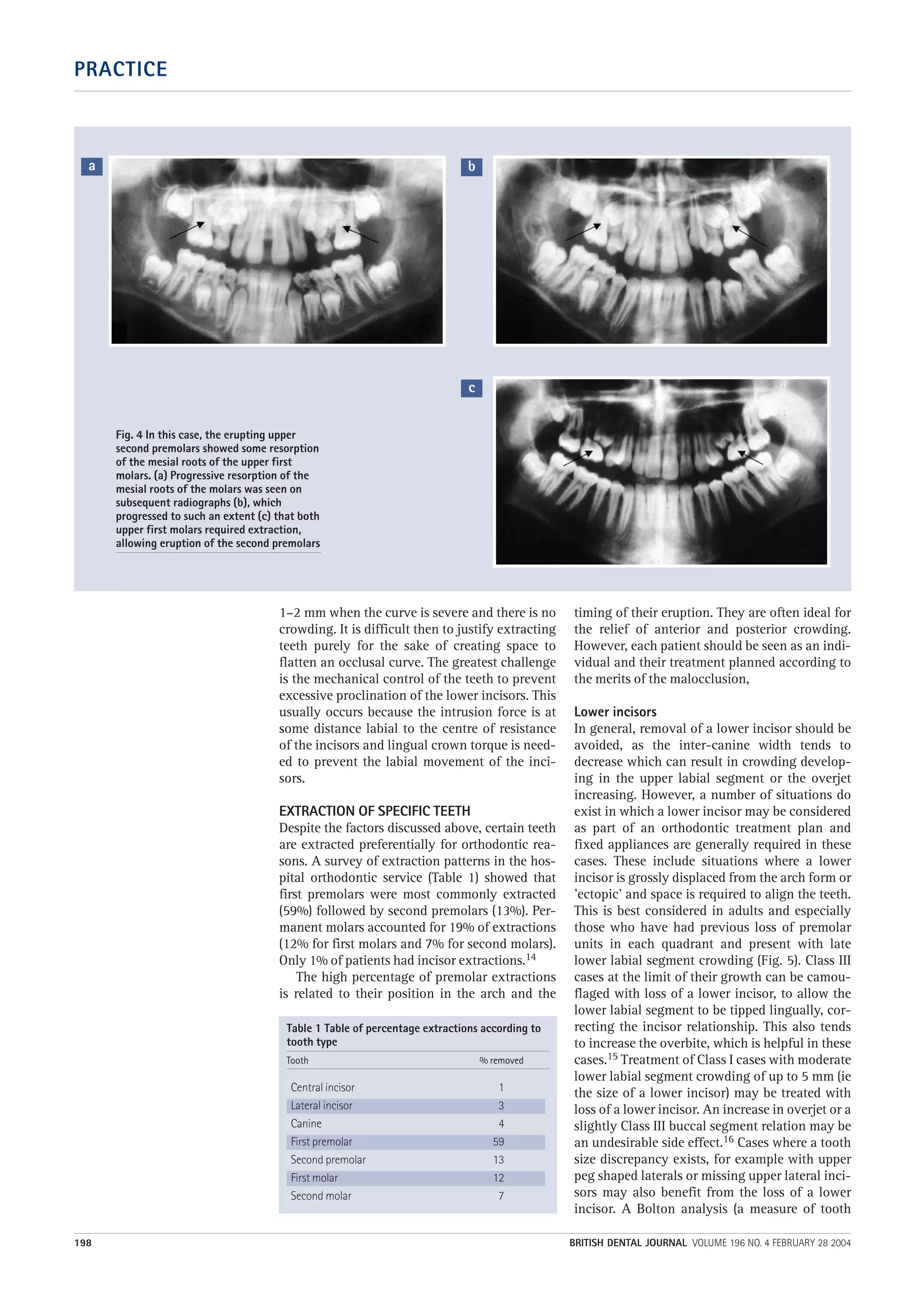 Part 8 extraction in orthodontics | PDF
