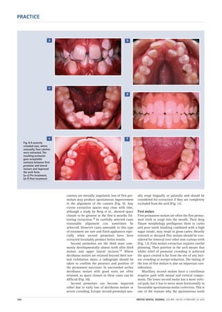 Part 8 extraction in orthodontics | PDF