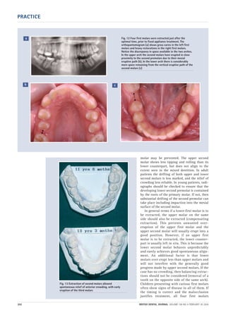 Part 8 extraction in orthodontics | PDF