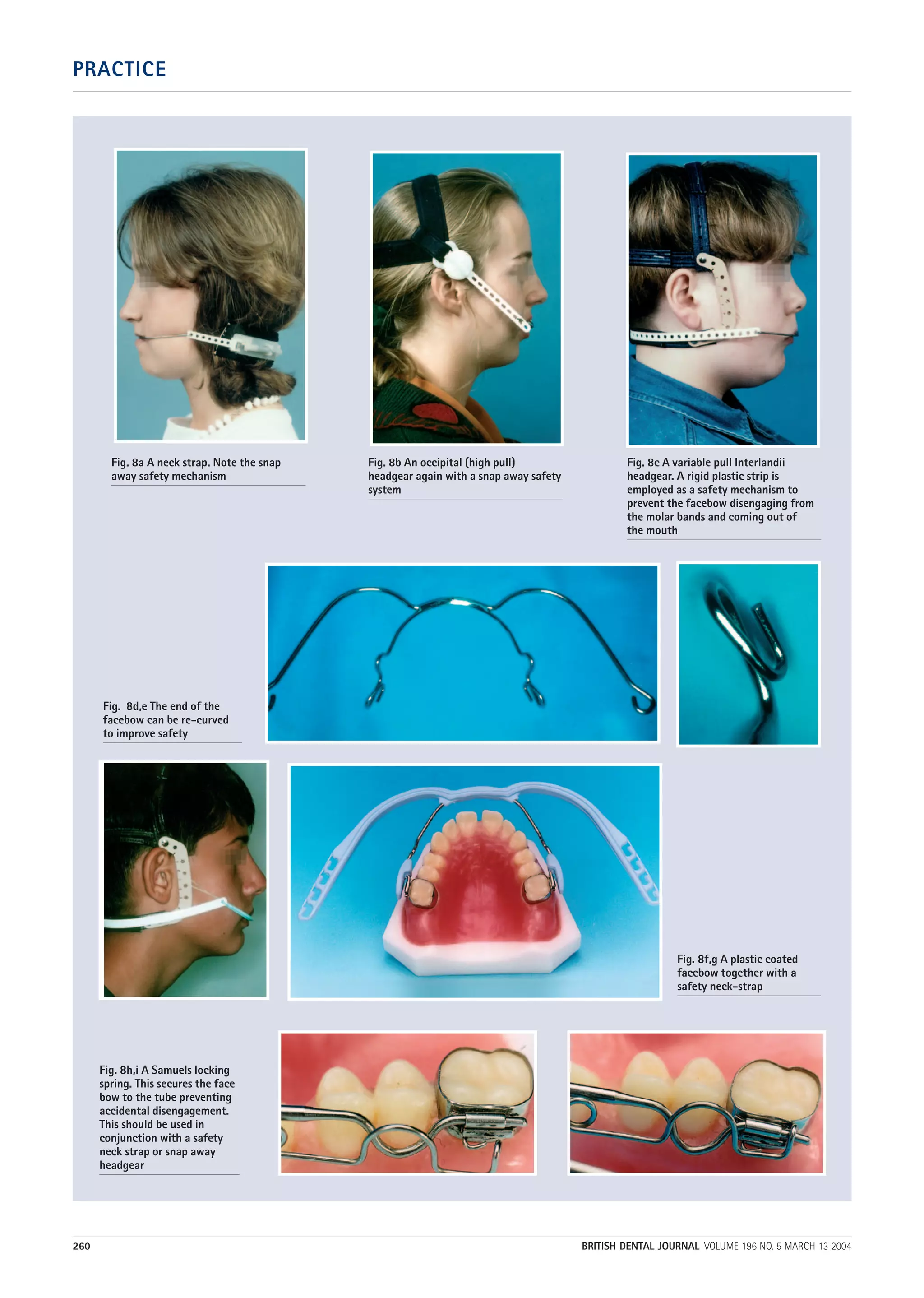 Part 9 anchorage control and distal movement | PDF