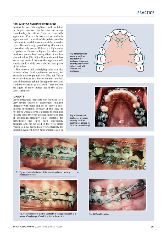 Part 9 anchorage control and distal movement | PDF