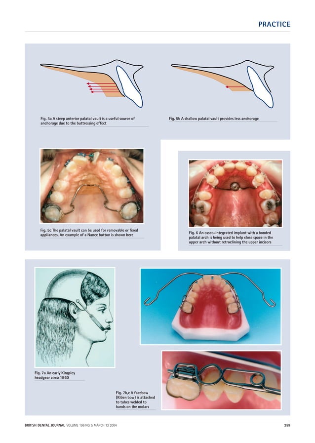 Part 9 anchorage control and distal movement | PDF