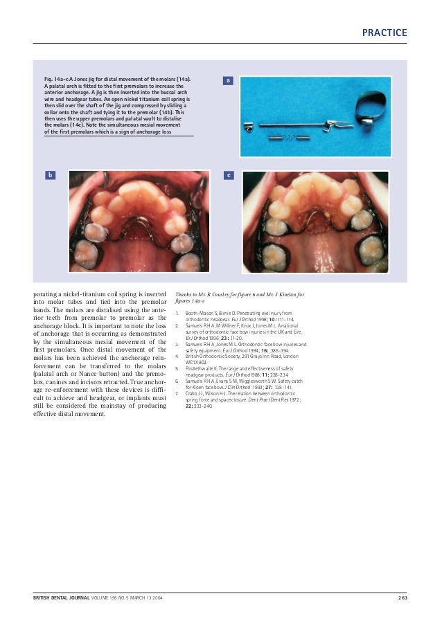 Part 9 Anchorage Control And Distal Movement
