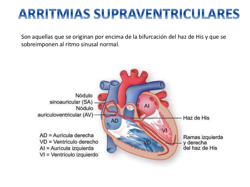 Arritmia Extra Sistólica Supraventricular - RETOEDU