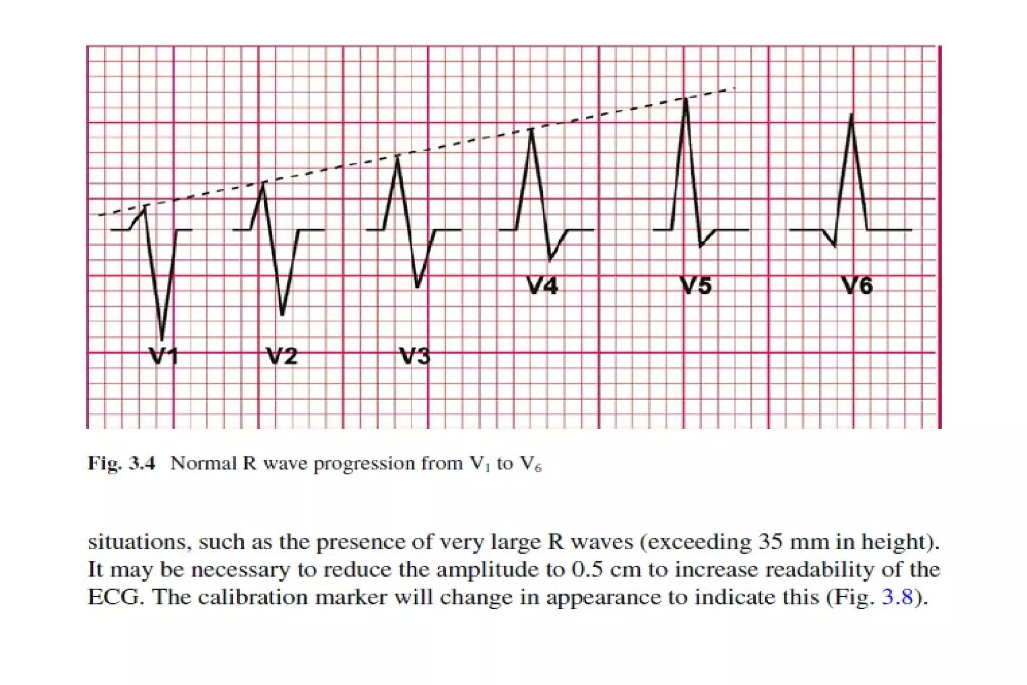 Part ecg stemi nstemi 2019 | PPT | Heart and Cardiovascular Diseases ...