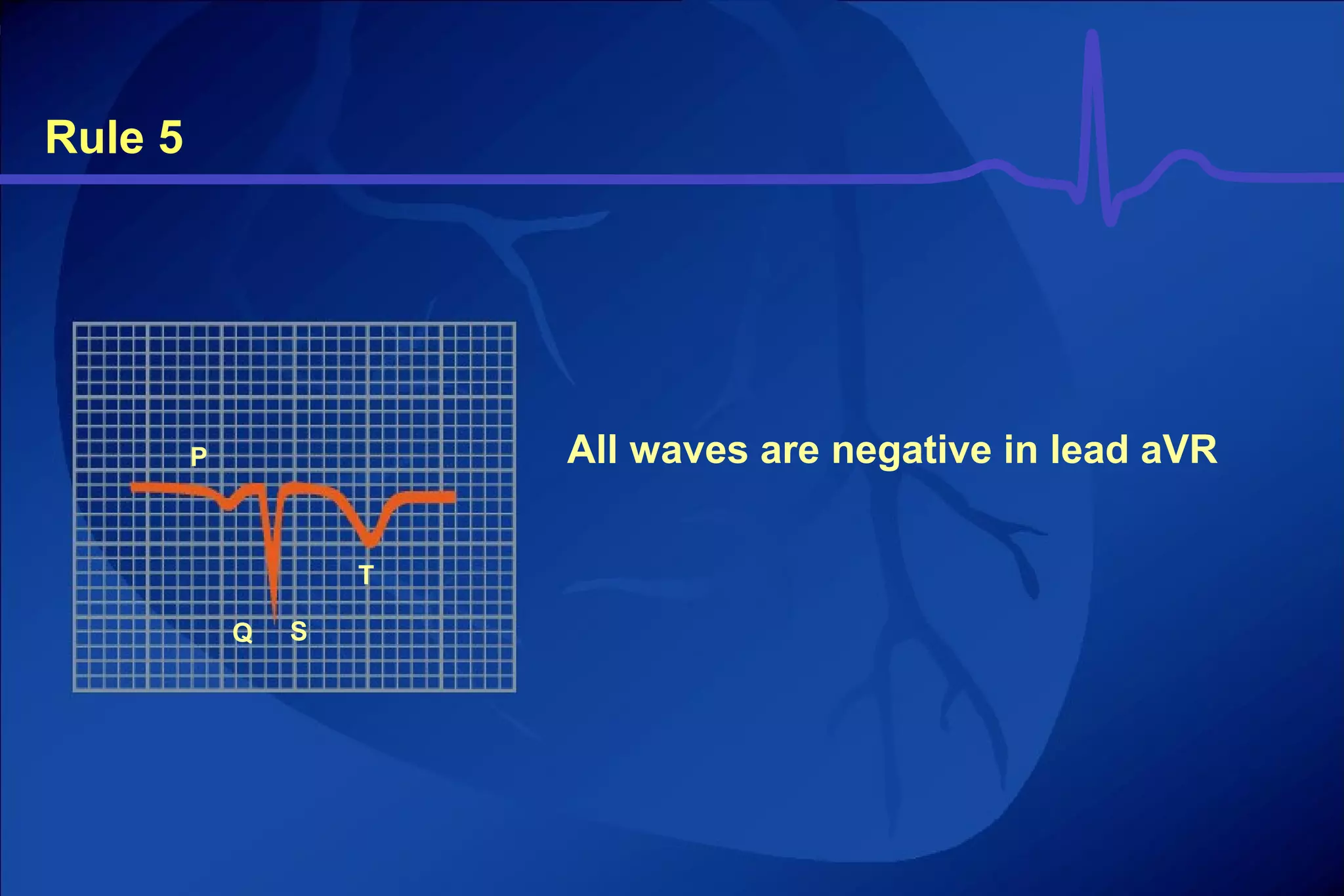 Part ecg stemi nstemi 2019 | PPT | Heart and Cardiovascular Diseases ...