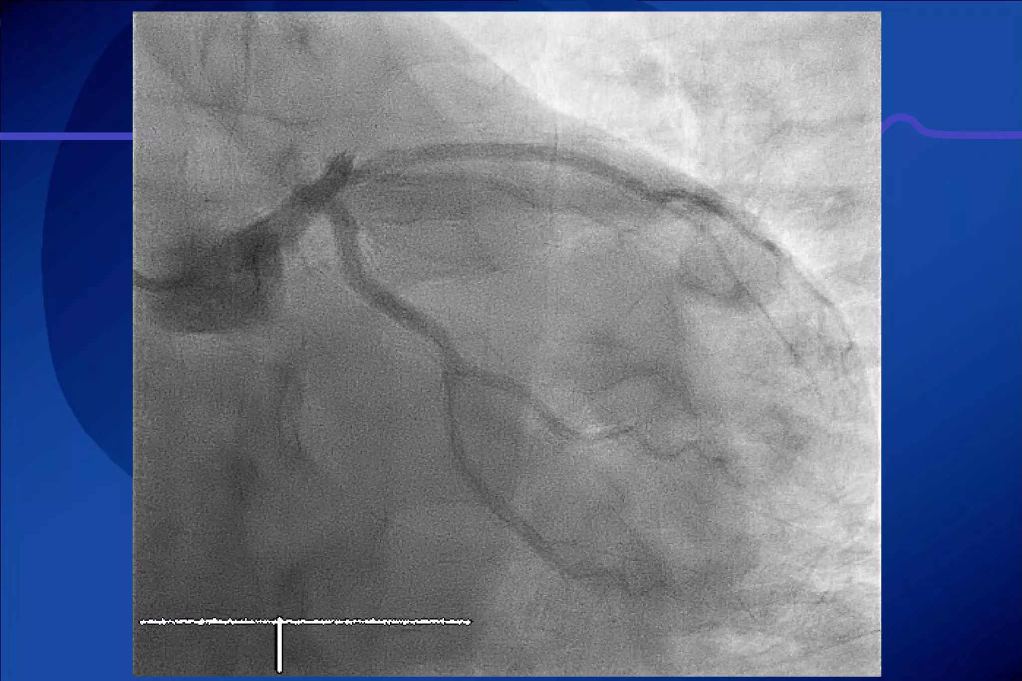 Part ecg stemi nstemi 2019 | PPT | Heart and Cardiovascular Diseases ...