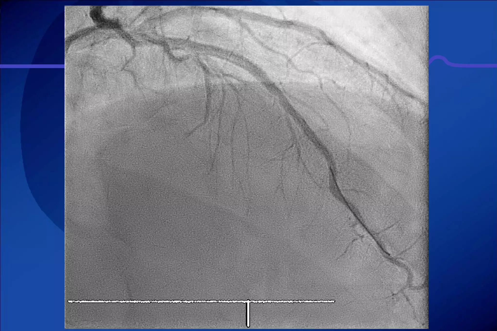 Part ecg stemi nstemi 2019 | PPT | Heart and Cardiovascular Diseases ...
