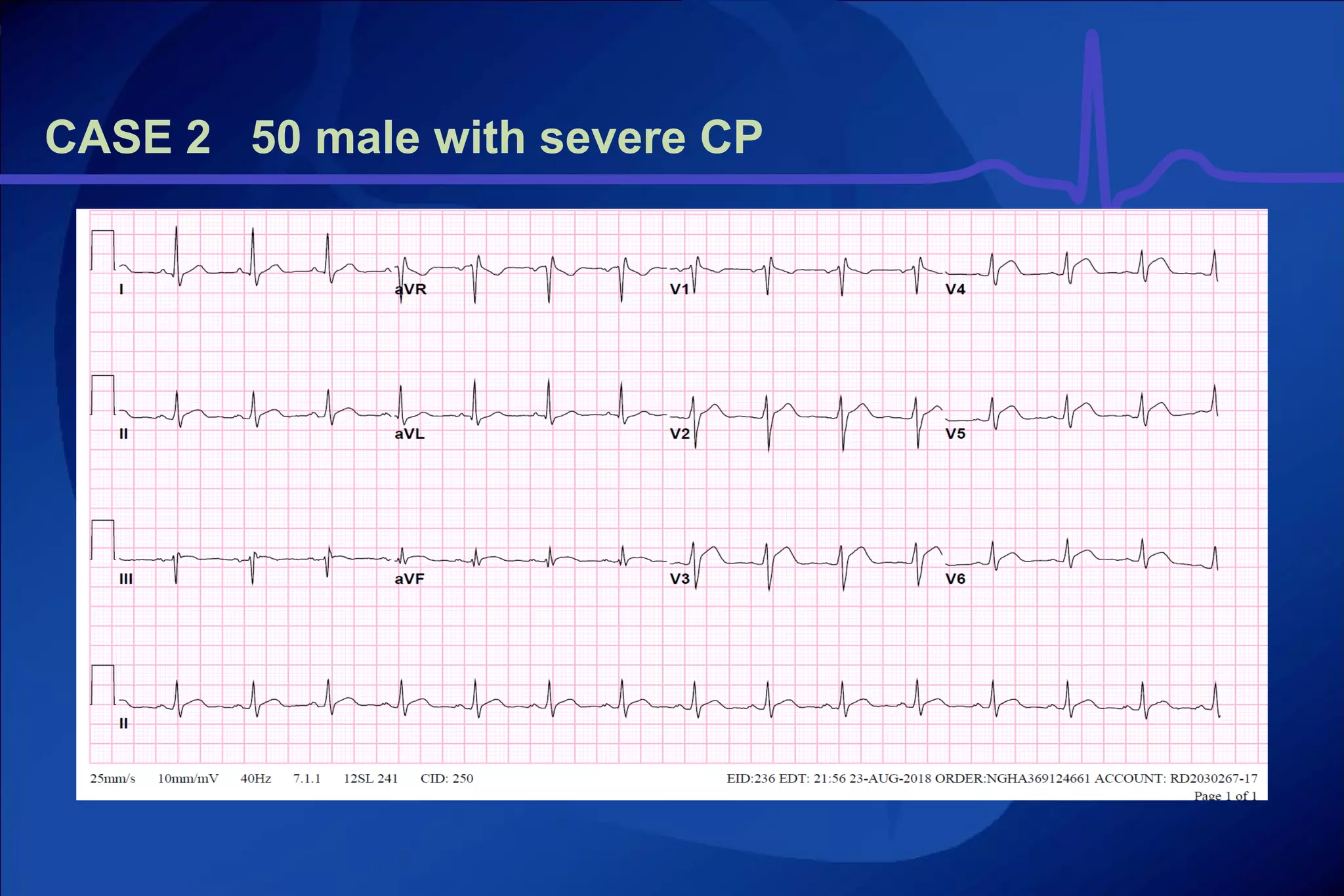 Part ecg stemi nstemi 2019 | PPT | Heart and Cardiovascular Diseases ...
