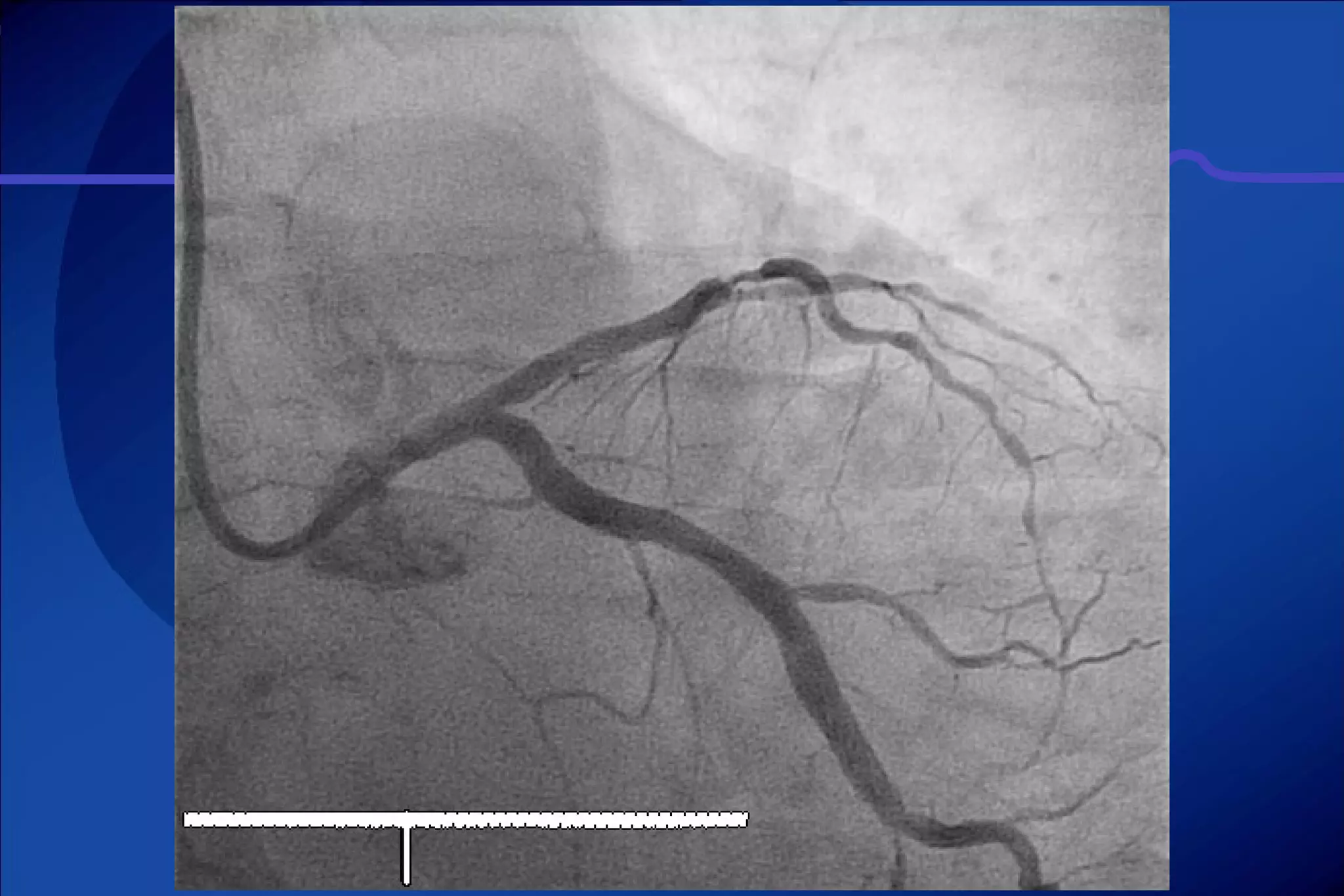 Part ecg stemi nstemi 2019 | PPT | Heart and Cardiovascular Diseases ...
