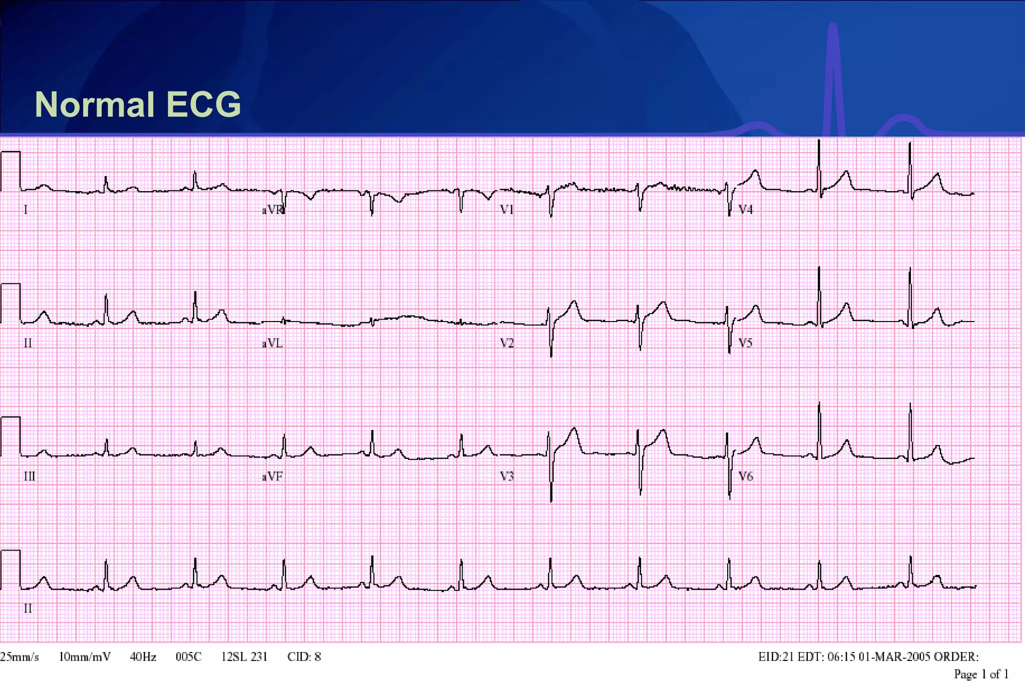 Part ecg stemi nstemi 2019 | PPT | Heart and Cardiovascular Diseases ...