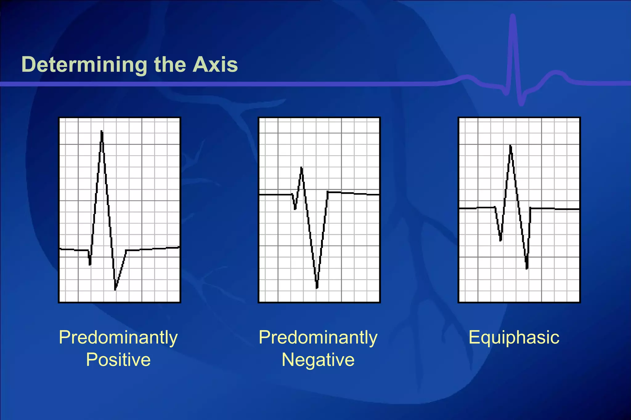 Part ecg stemi nstemi 2019 | PPT | Heart and Cardiovascular Diseases ...