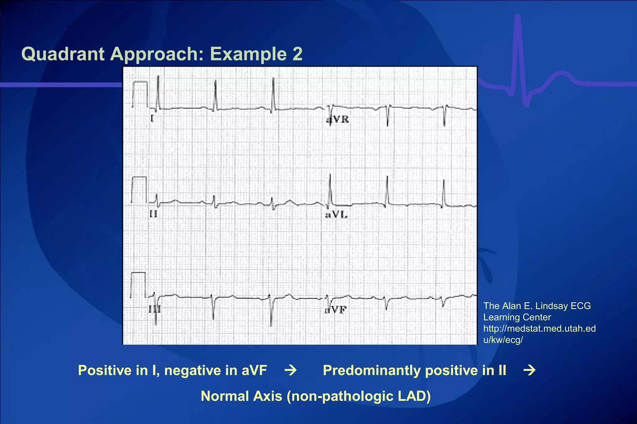 Part ecg stemi nstemi 2019 | PPT | Heart and Cardiovascular Diseases ...