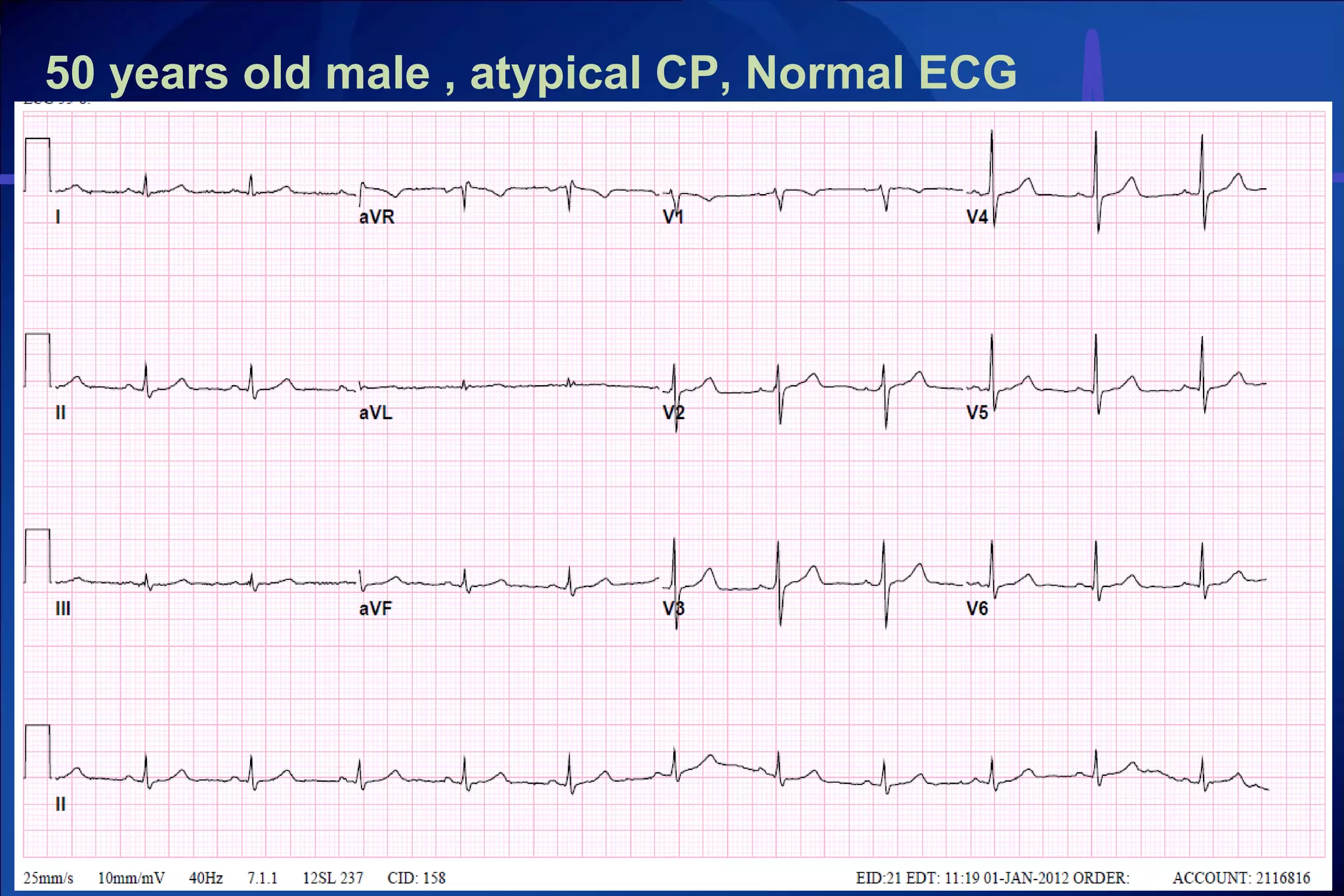 Part ecg stemi nstemi 2019 | PPT | Heart and Cardiovascular Diseases ...