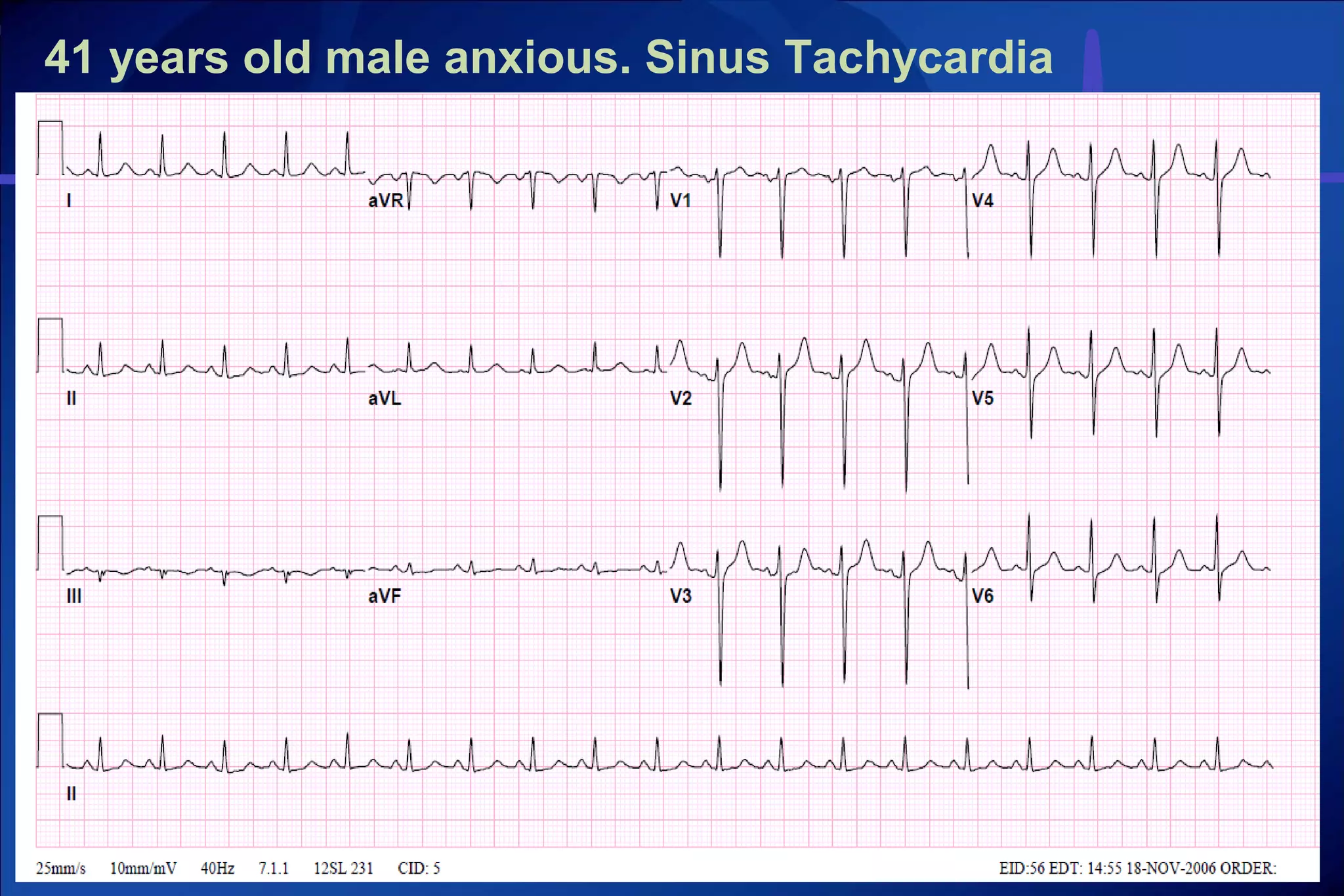 Part ecg stemi nstemi 2019 | PPT | Heart and Cardiovascular Diseases ...
