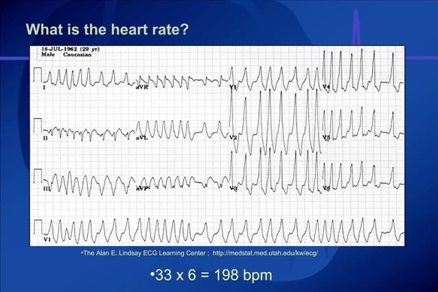 Part ecg stemi nstemi 2019 | PPT | Heart and Cardiovascular Diseases ...